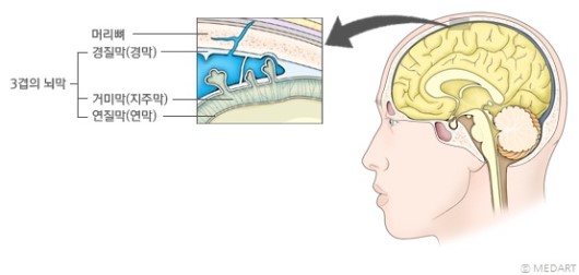 외상성 경막하출혈과 자발성비외상성경막하출혈 뇌출혈뇌졸중진단비 특약 보상여부 네이버 블로그