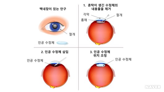 백내장 수술 입원치료 인정한 판례와 통원 치료로 본 판례 비교 네이버 블로그